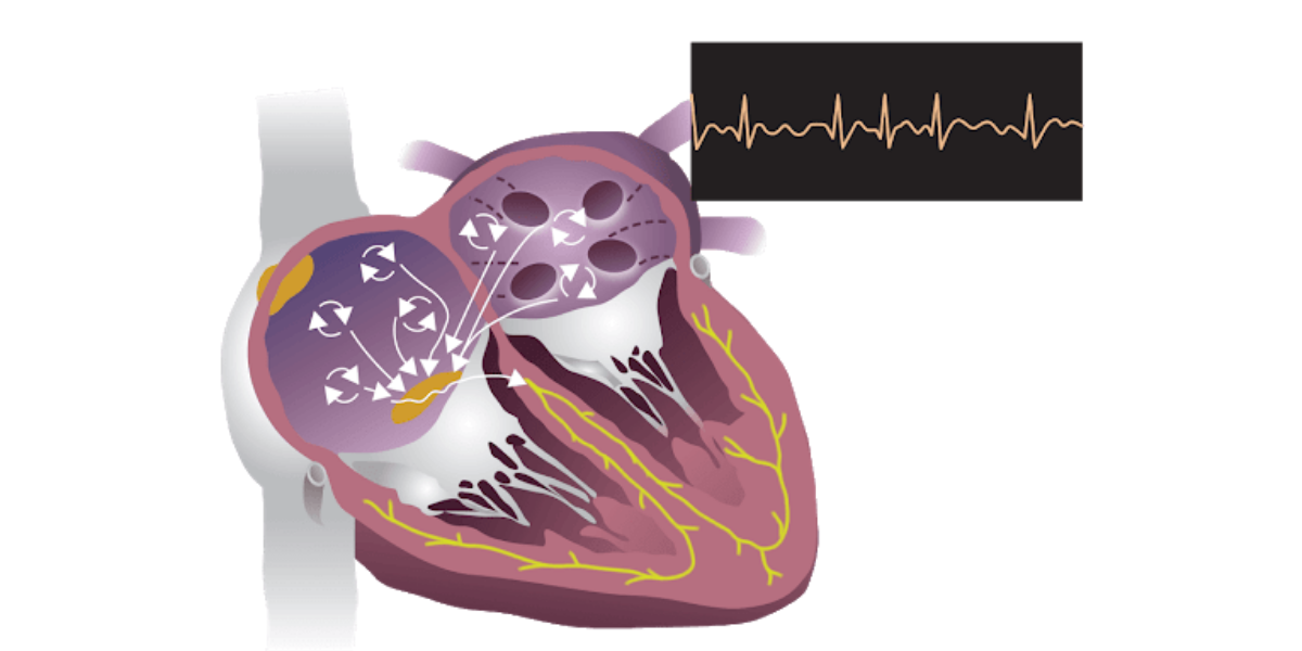Fibrilação Atrial Insituto De Ritmologia Cardíaca